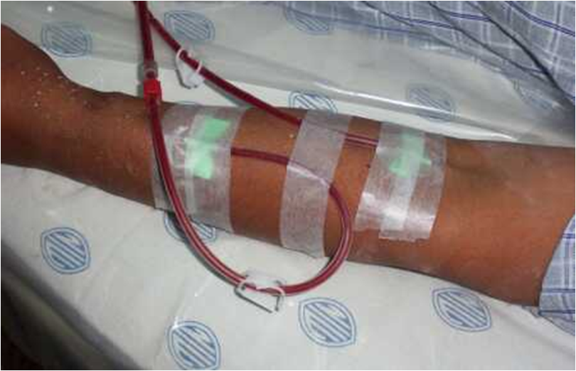 Hemodialysis – Sapiens Health Foundation